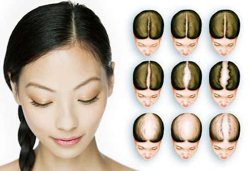 Hair loss treatment for women - Female hair restoration